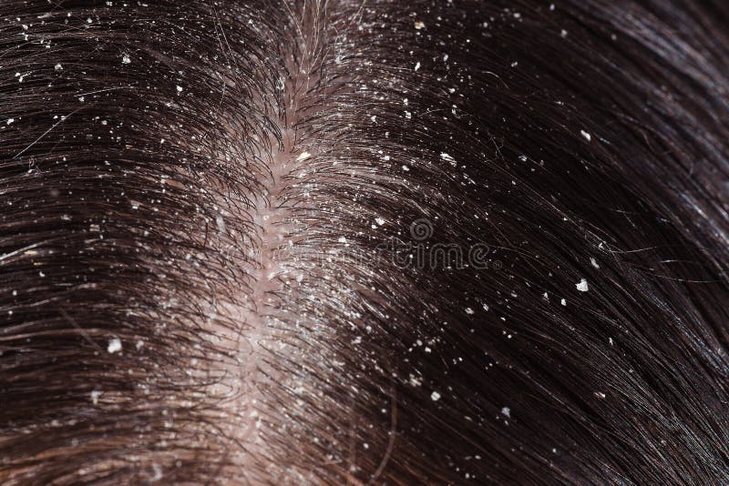 Cuir Chevelu De Cheveux Avec Des Pellicules Et écallieux Du Psoriasis ...