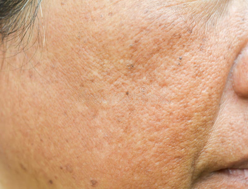 Pecas en la cara imagen de archivo. Imagen de adulto - 114187905