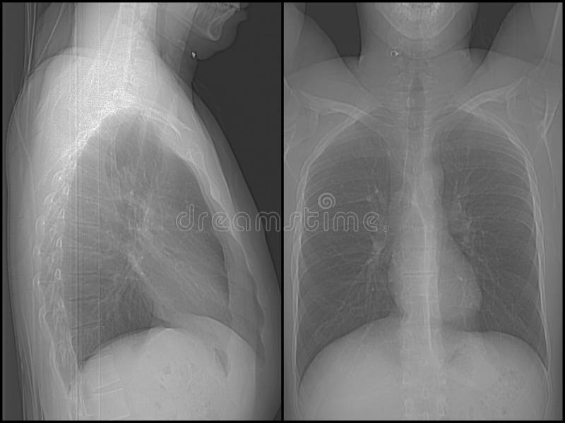 Pecho Normal En Radiografía Foto de archivo - Imagen de pulmonar ...