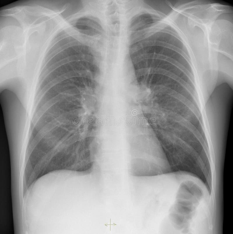 Pecho Normal En Radiografía Foto de archivo - Imagen de médico ...