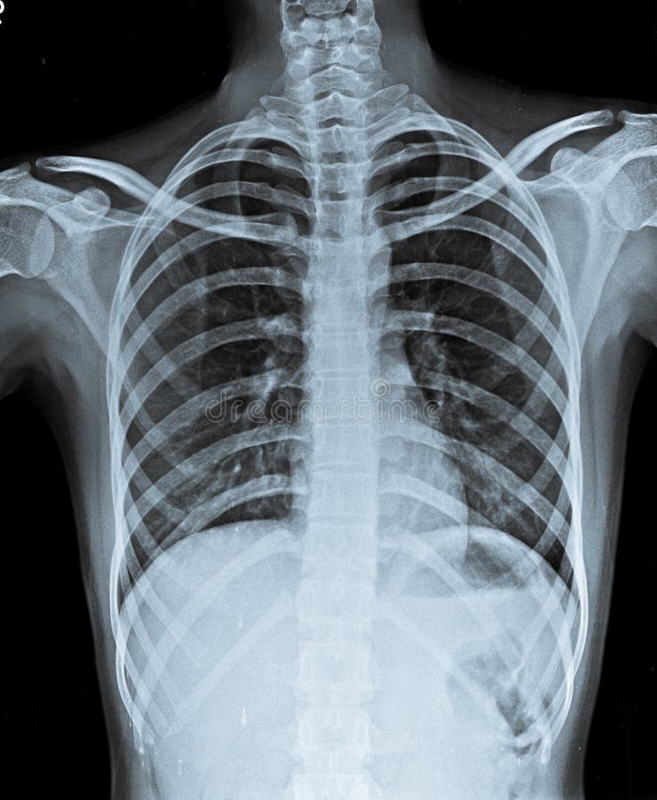 La Radiografía Normal De La Radiografía Del Pecho, Pulmón Y Oye Foto de ...