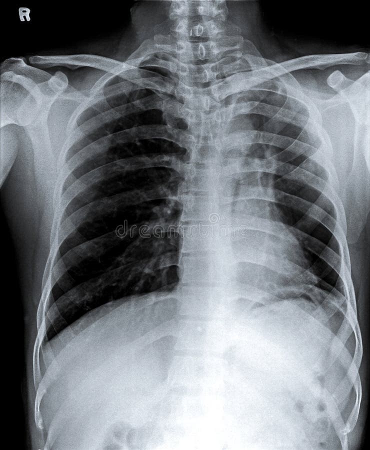 Pecho Normal X Ray Del Ser Humano Foto de archivo - Imagen de médico ...