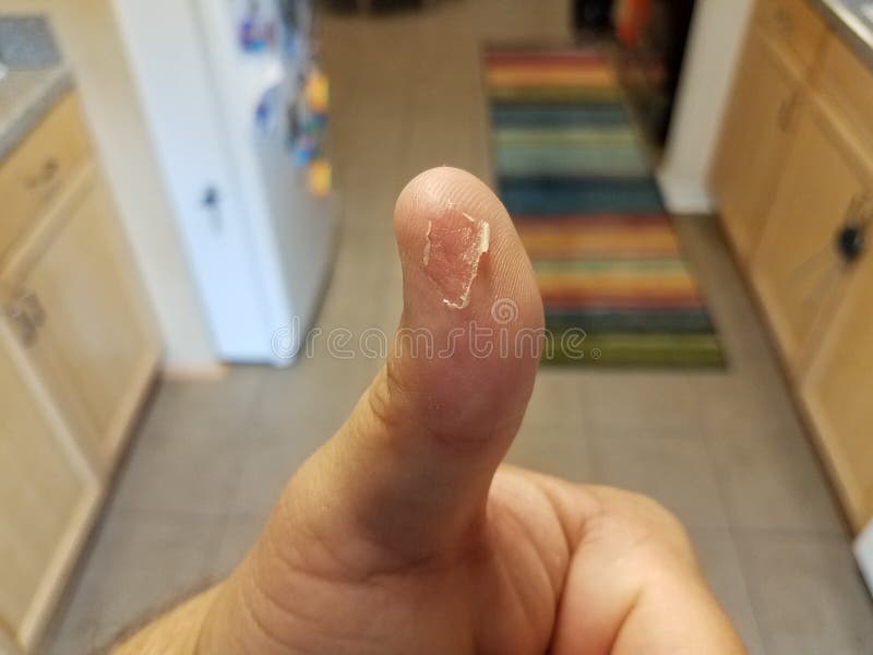 Peeling or Flaking Skin on Thumb in Kitchen Stock Photo - Image of ...