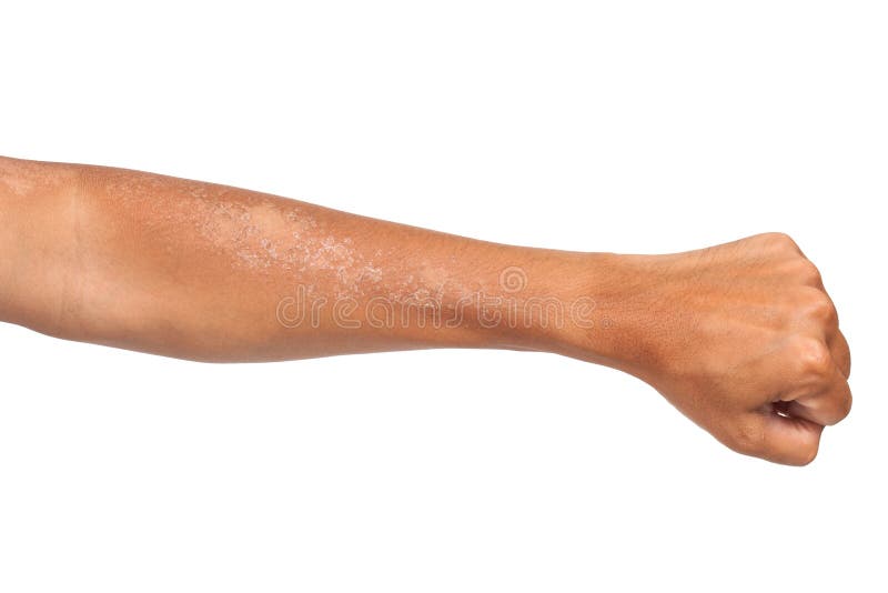 Peeling of Skin after Burned by Sunlight Stock Photo - Image of painful ...