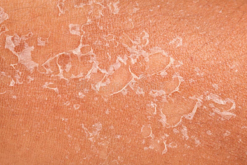 Peeling Of Skin After Burned By Sunlight Stock Photo - Image of illness ...