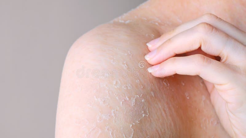 Peeling Skin Close-up Skin Problems on Shoulder Scratching Shoulder ...