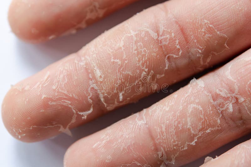 Peeling Skin on Hand and Fingers. Desquamation Stock Photo - Image of ...