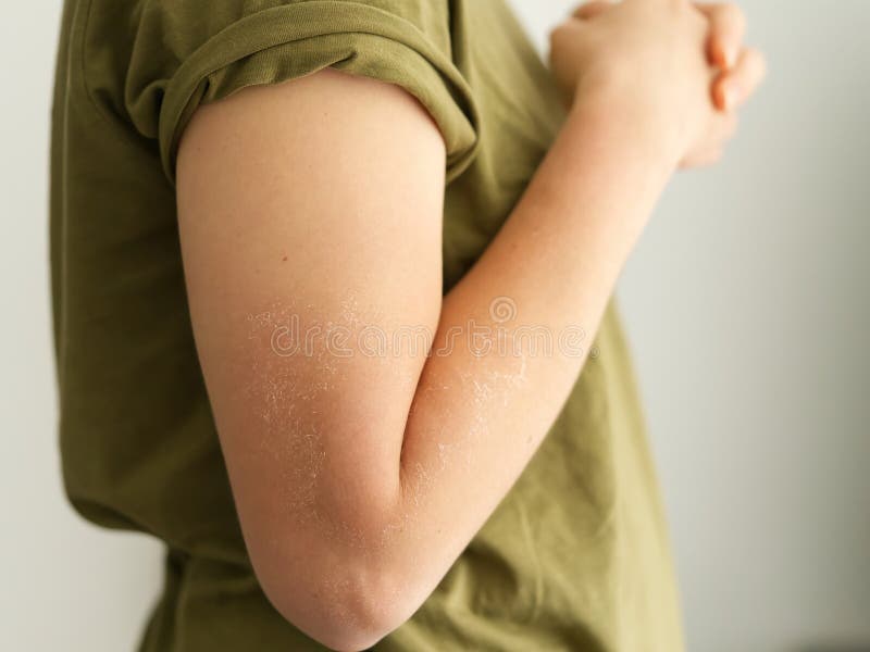 Peeling Skin At Shoulder From Sunburn Effect On Body Of Young Woman