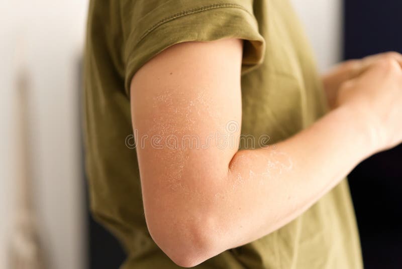 Peeling Skin At Shoulder From Sunburn Effect On Body Of Young Woman