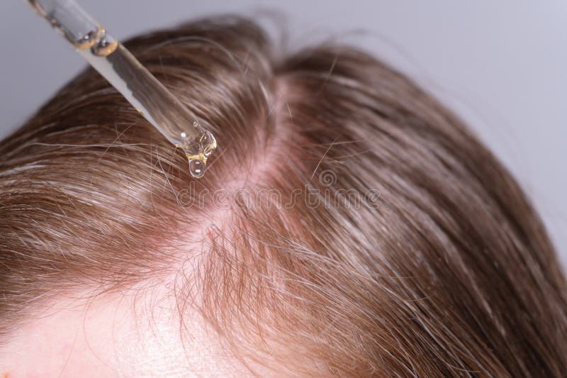 Precise Application of a Scalp Peeling Solution with a Pipette is ...