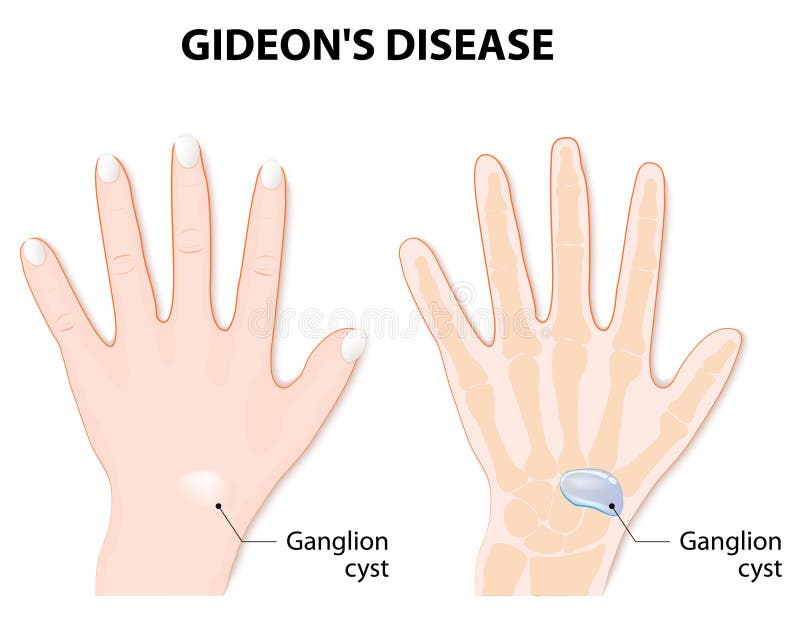 De Cysteillustratie Peesknoopvoet Van De Vector Illustratie ...