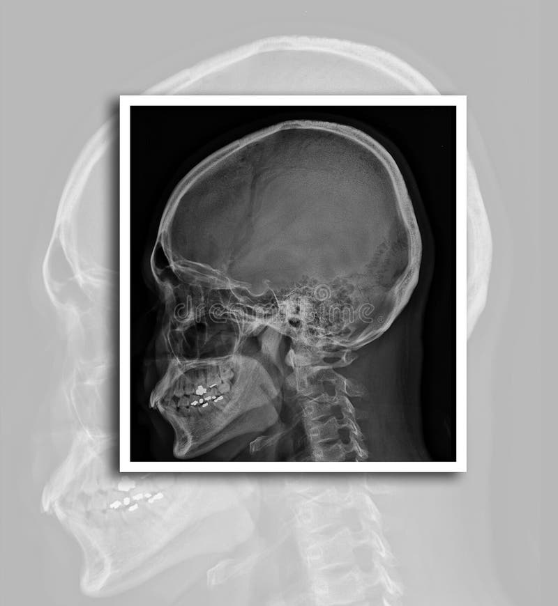 Película de radiografía foto de archivo. Imagen de vena - 20454564