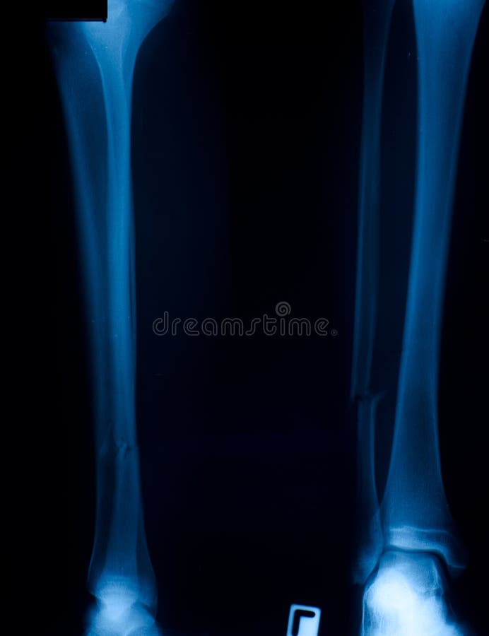 Radiografía De La Tibia Fracturada Imagen de archivo - Imagen de rayo ...