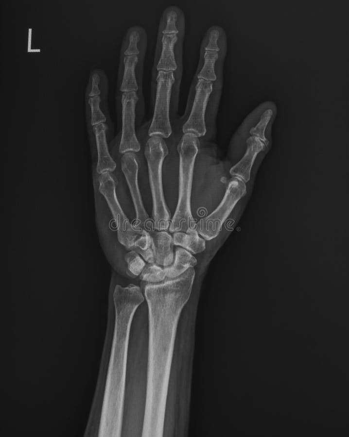Película De Radiografía De La Mano Foto de archivo - Imagen de mano ...