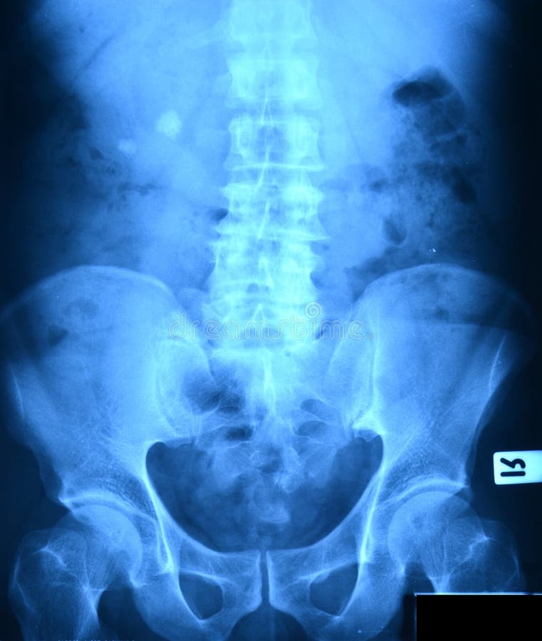 Radiografía del abdomen imagen de archivo. Imagen de estructura - 1533985