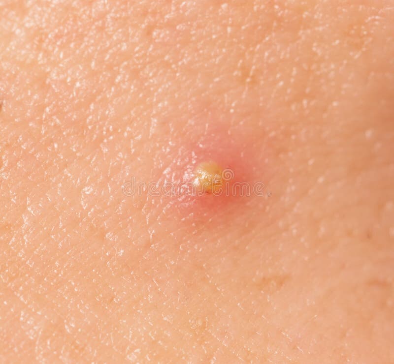 Pele Acne Inflamada Como Pano De Fundo Foto de Stock - Imagem de ...