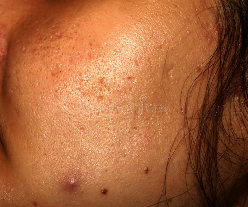 Pele Inflamada Da Cara Nas Espinhas E Na Acne O Keloid Scars Da Acne ...