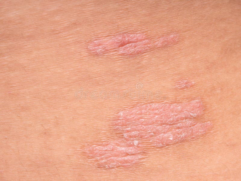 Psoriasi, Malattia Della Pelle Immagine Stock - Immagine di piede ...