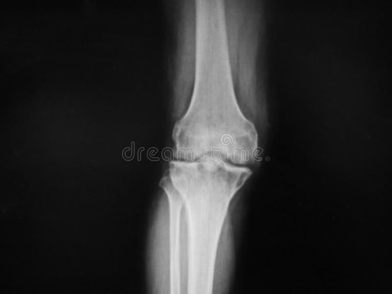 Pellicule Xray Noir Et Blanc Du Genou Et De La Jambe Photo stock ...