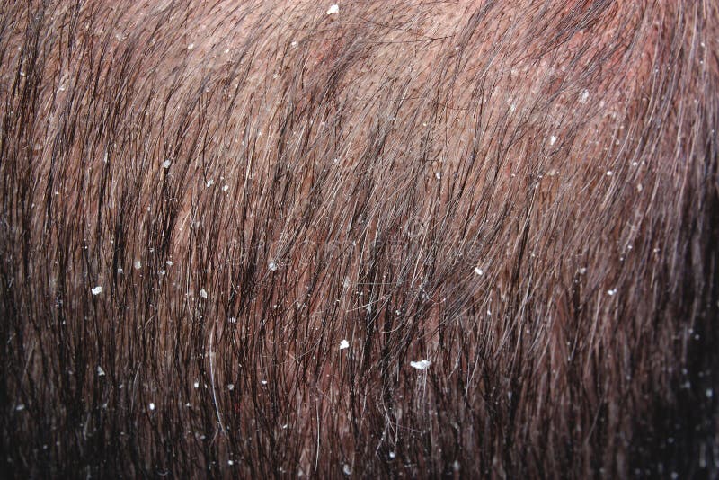Pellicules Dans Les Cheveux Cuir Chevelu Floconneux Photo stock - Image ...