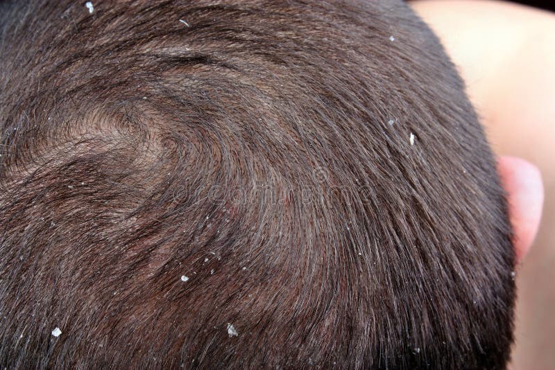 Pellicules Dans Les Cheveux Image stock - Image du émission, noir: 37229969