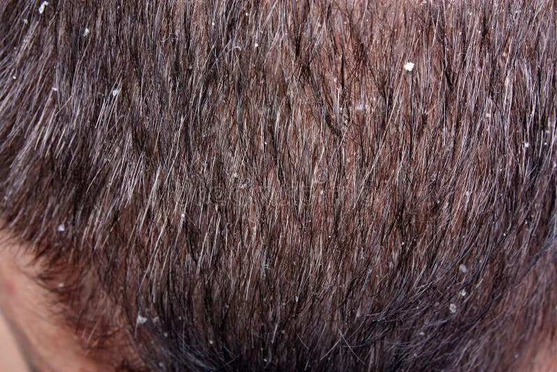 Pellicules Dans Les Cheveux Photo stock - Image of tête, régime: 76060708