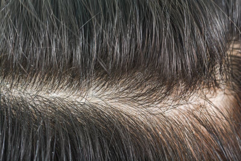 Pellicules Et Cuir Chevelu De Pellicules De Cheveux Image stock - Image ...