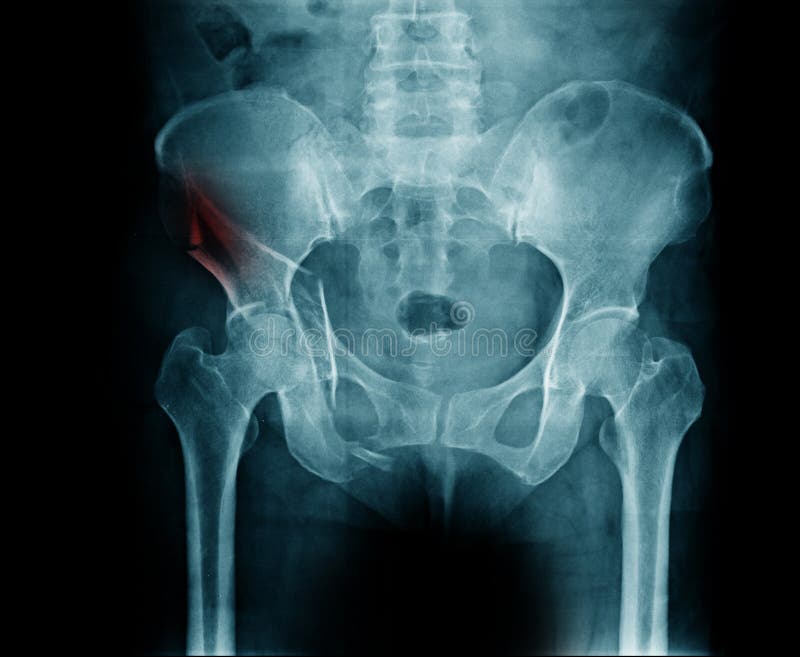 Fractura En Pelvis