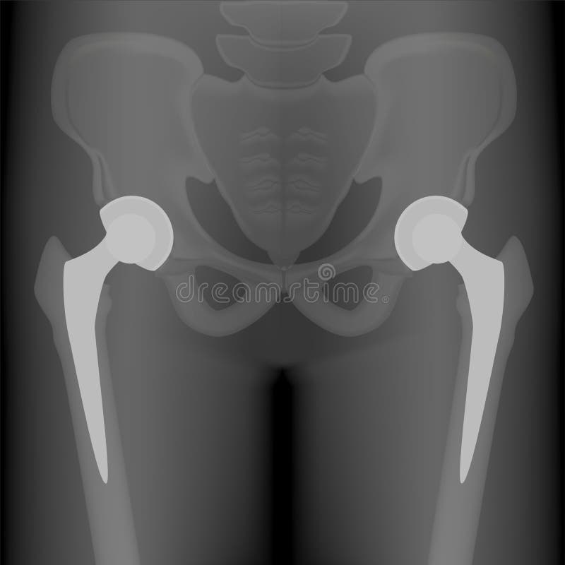 Pelvis and Hip Joint Problem_Bilateral Hip Replacement Stock Vector ...