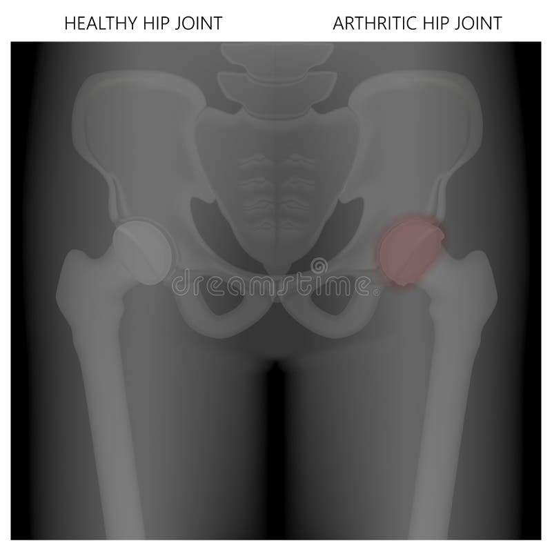 Pain In The Hip Joint_femur Fracture Stock Vector - Illustration of ...
