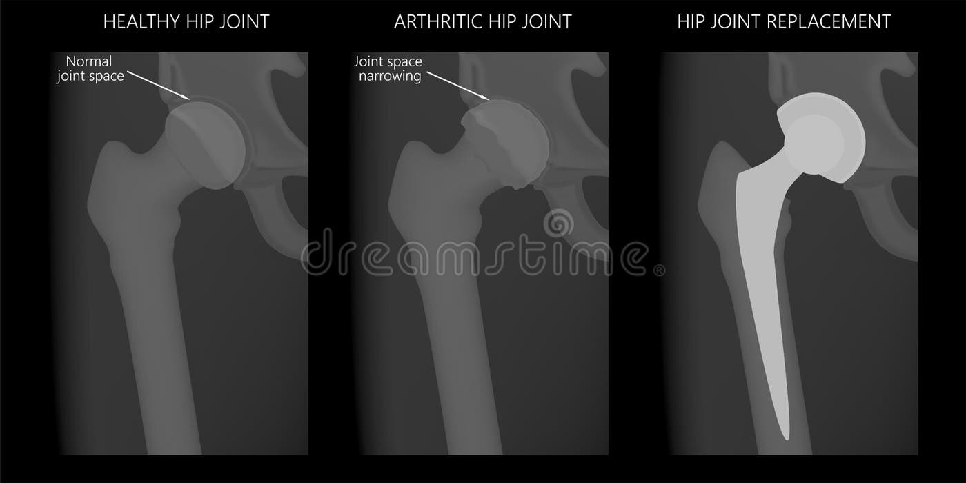 Total Hip Replacement Arthroplasty Stock Illustrations – 51 Total Hip ...