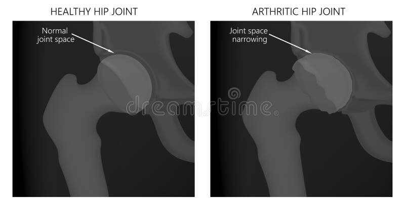 Pelvis And Hip Joint Problemhip Dysplasia And Dislocation Stock Vector Illustration Of Body