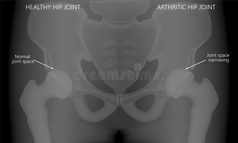 Pelvis and Hip Joint Problem_Hip Dysplasia and Dislocation Stock Vector ...