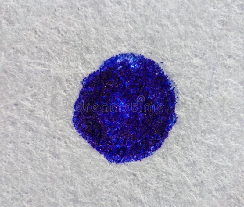 Extreme CU Shot, Skin with Psoriasis on the Elbow Stock Image - Image ...