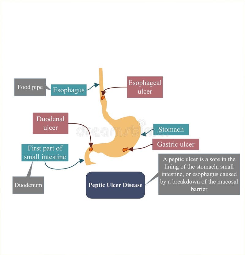 Peptic Ulcer Disease Relates To Ulcer Stock Image - Image of abdominal ...