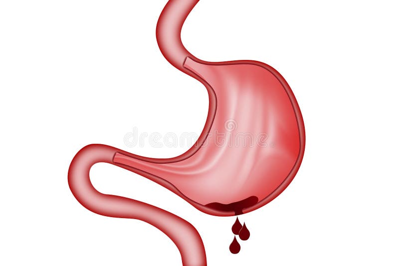 Stomach Bleeding Stock Illustrations – 435 Stomach Bleeding Stock ...