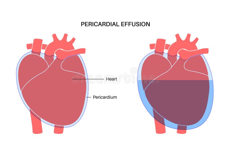 Pericarditis Stock Illustrations – 185 Pericarditis Stock Illustrations ...