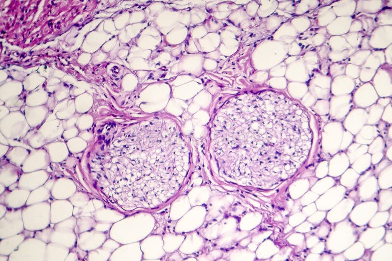 Pericarditis, Light Micrograph, Photo Under Microscope Stock Photo ...