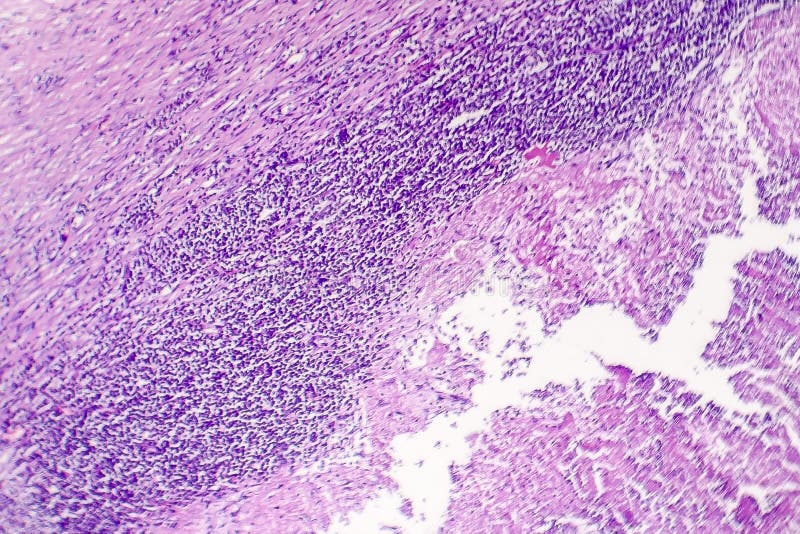 Pericarditis, Light Micrograph, Photo Under Microscope Stock Photo ...