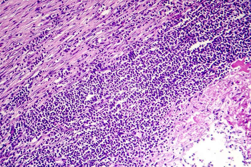 Pericarditis, Light Micrograph, Photo Under Microscope Stock Photo ...