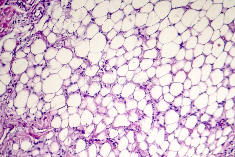 Pericarditis, Light Micrograph, Photo Under Microscope Stock Photo ...