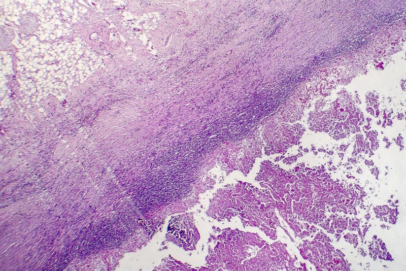 Pericarditis, Light Micrograph, Photo Under Microscope Stock Photo ...