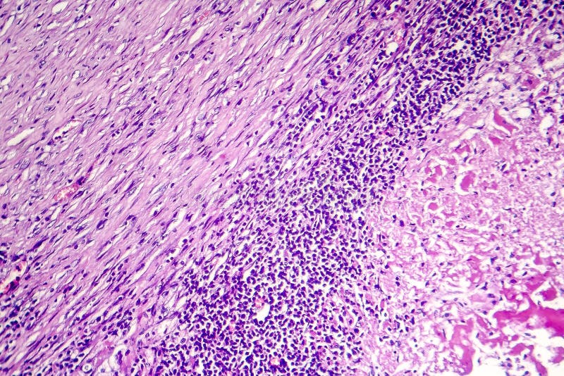 Pericarditis, Light Micrograph, Photo Under Microscope Stock Photo ...