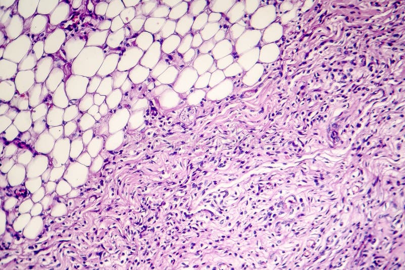 Pericarditis, Light Micrograph, Photo Under Microscope Stock Photo ...