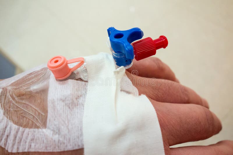 Perifer Venös Katetervenflon I Hand Arkivfoto - Bild av klinik, skada ...