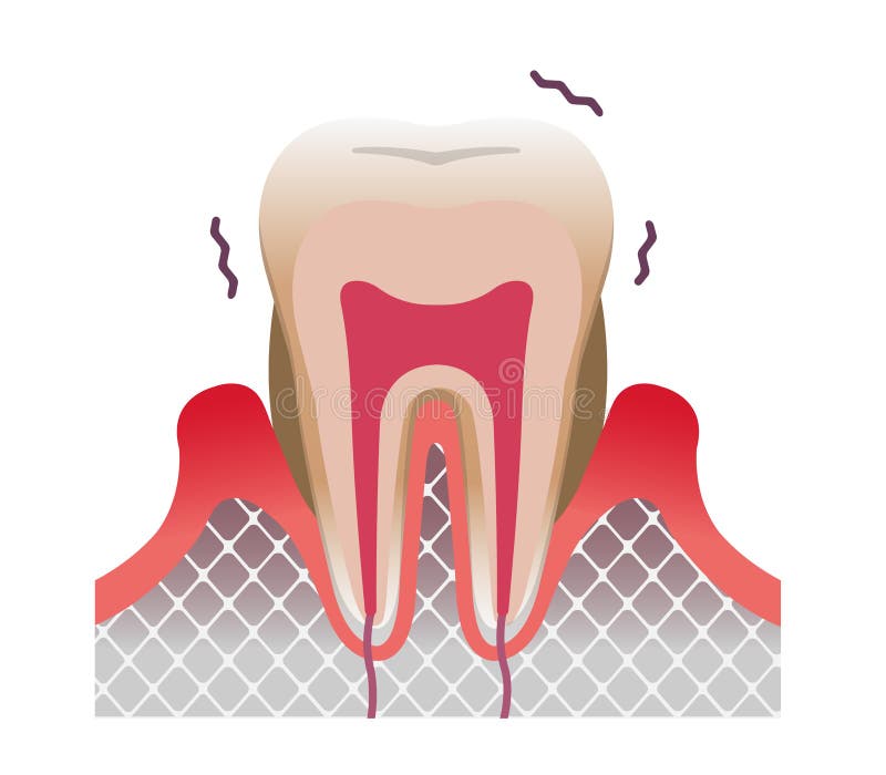 The Stages of Periodontitis Disease Vector Illustration Stock Vector ... The Stages of Periodontitis Disease Vector Illustration Stock Vector ...
