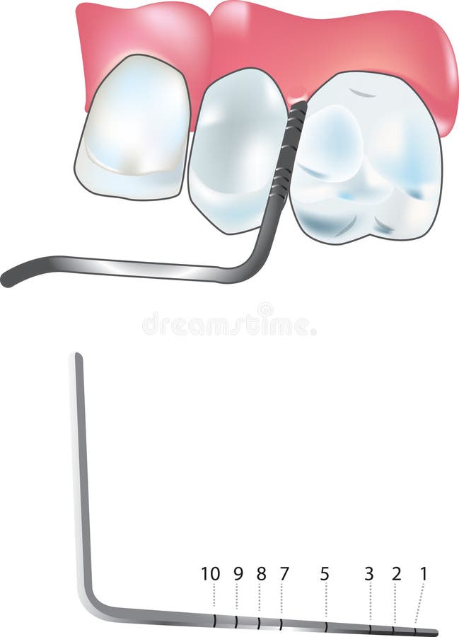 Periodontal probe stock vector. Illustration of surgery - 23485053