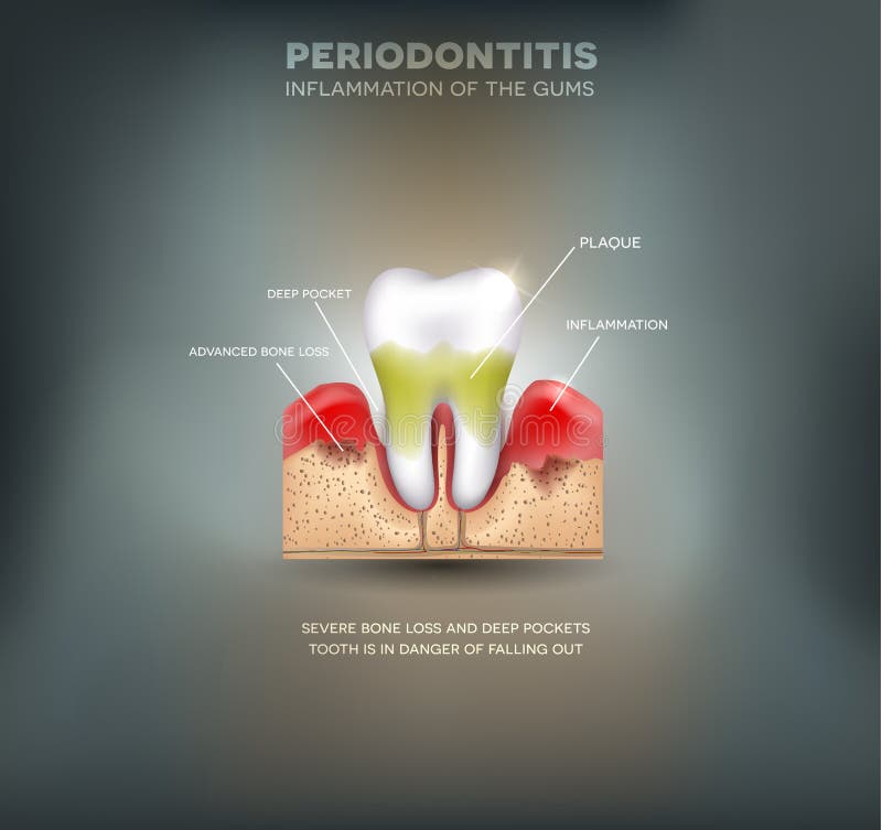 Póster Dental De Periodontitis Ilustración del Vector - Ilustración de ...