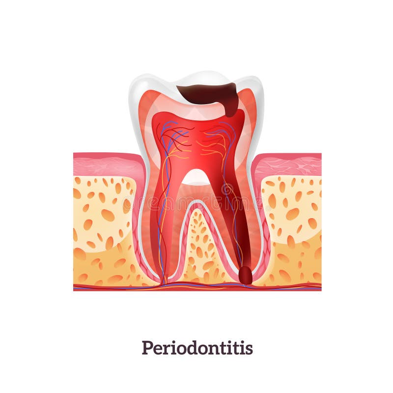 Periodontitis Realistic Illustration Stock Vector - Illustration of ...