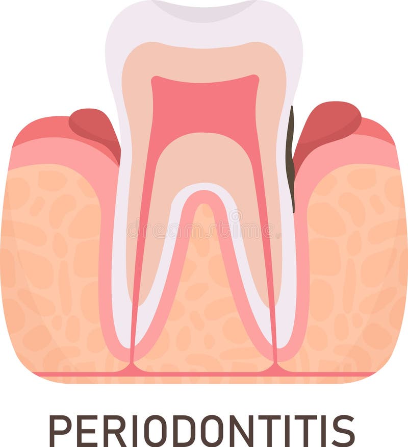 Periodontitis Tooth and Gums. Periodontal Pocket and Bone Destruction ...